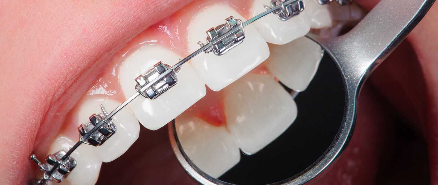 Orthodontic Treatments Singapore | emBRACE Dental Surgery